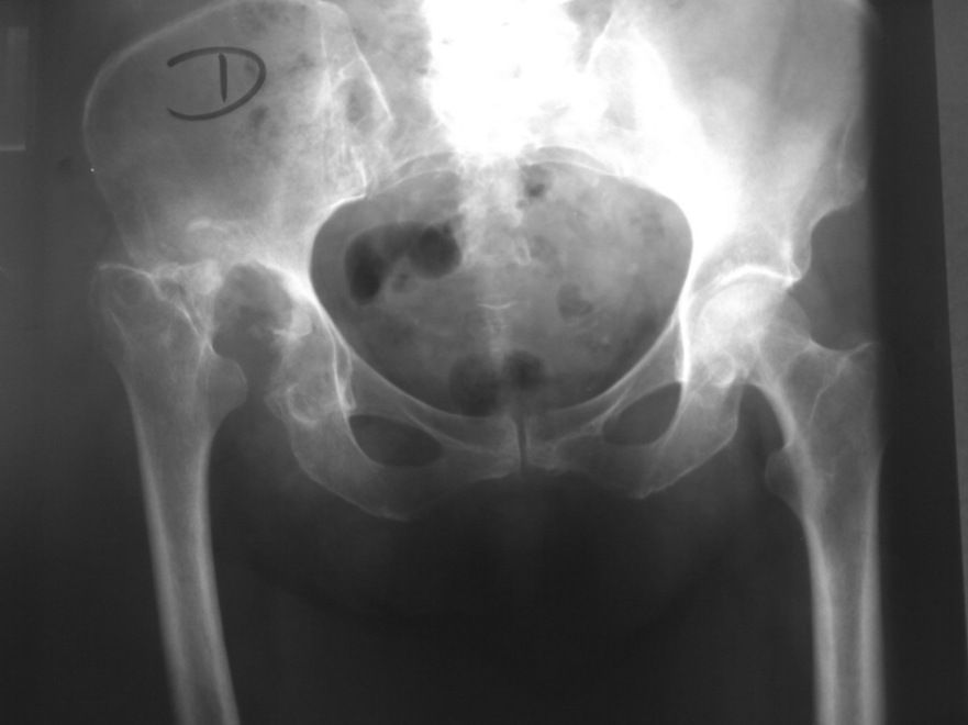Displasia de cadera | CLINICA TRAUMATOLOGICA DR. CALVO